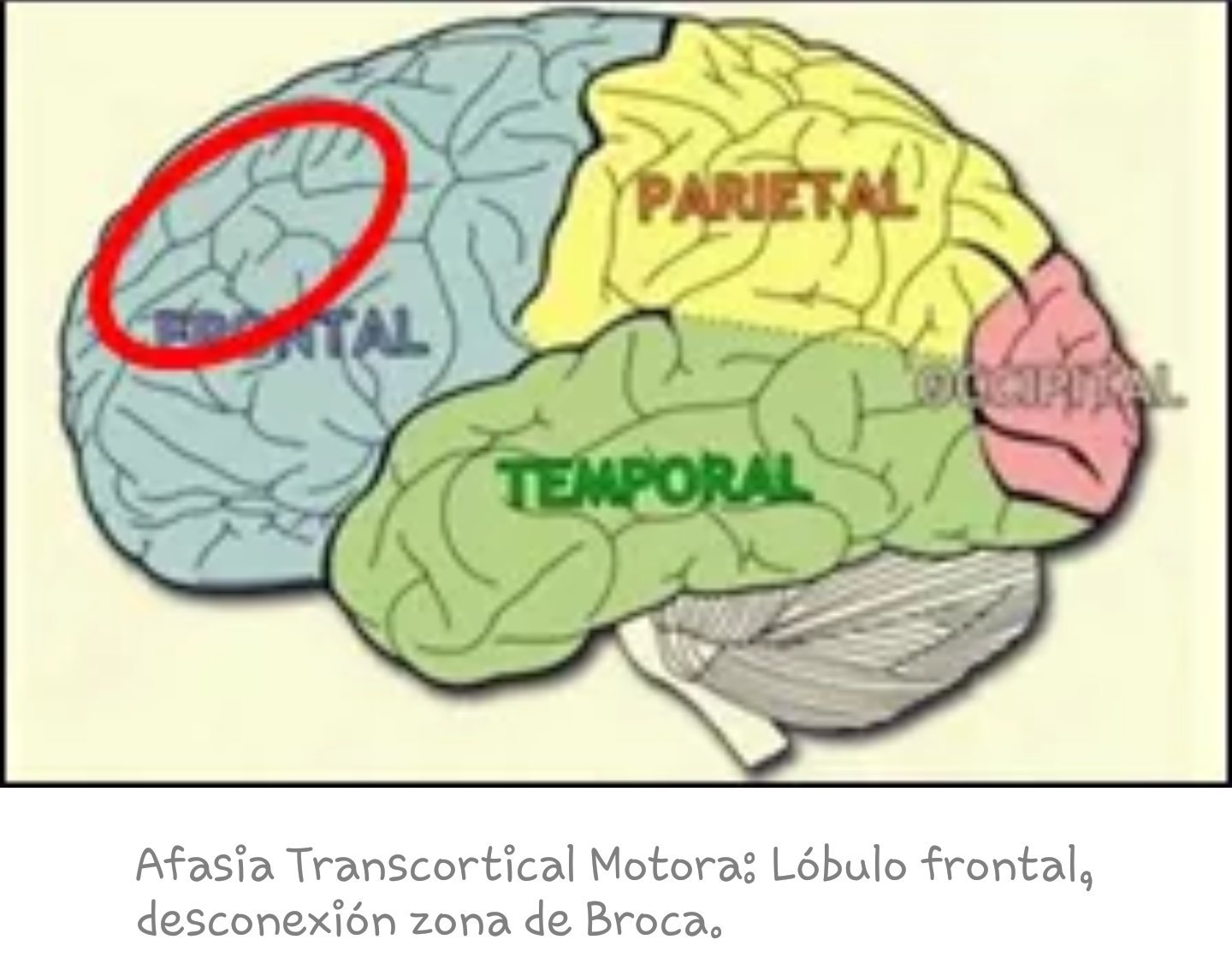 Afasia: Definición, tipos y características - NeuroClass