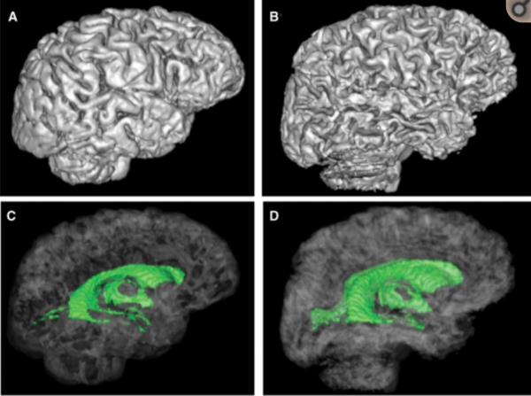 Síndrome Wernicke-Korsakoff: Causas y efectos - NeuroClass Síndrome Wernicke-Korsakoff: Causas y efectos - NeuroClass