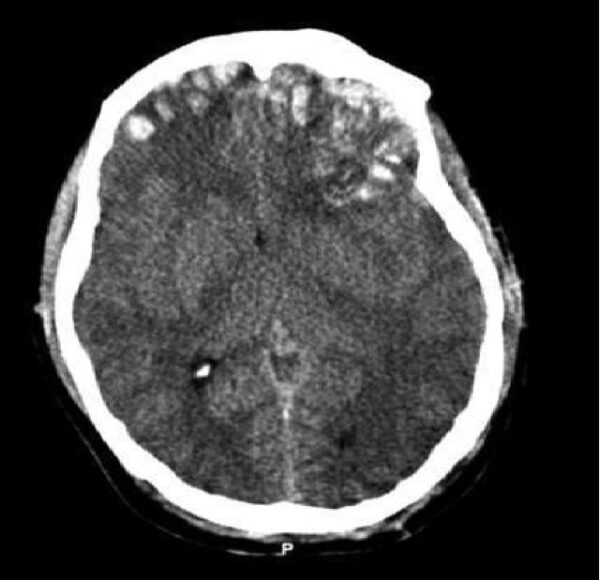 Trauma craneoencefálico: ¿Cómo pronosticar? - NeuroClass