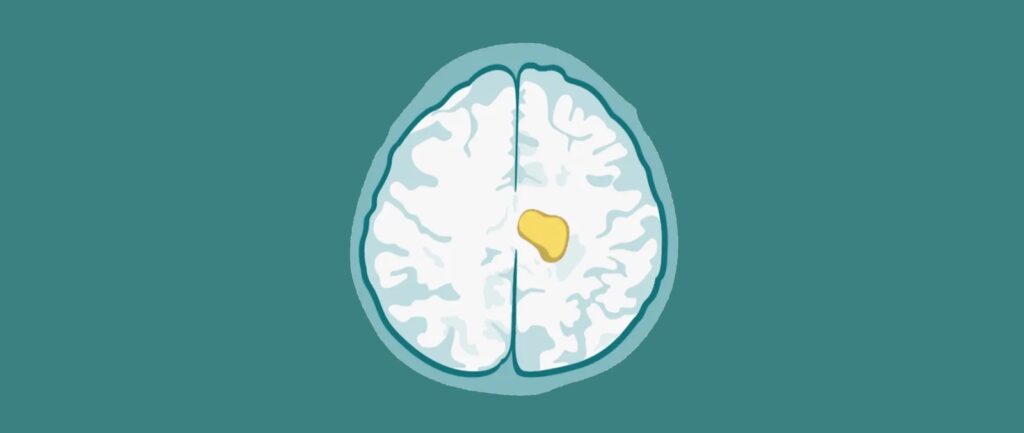 absceso cerebral Archives - NeuroClass