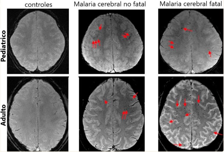 Malaria cerebral: Efectos neuropsicológicos - NeuroClass
