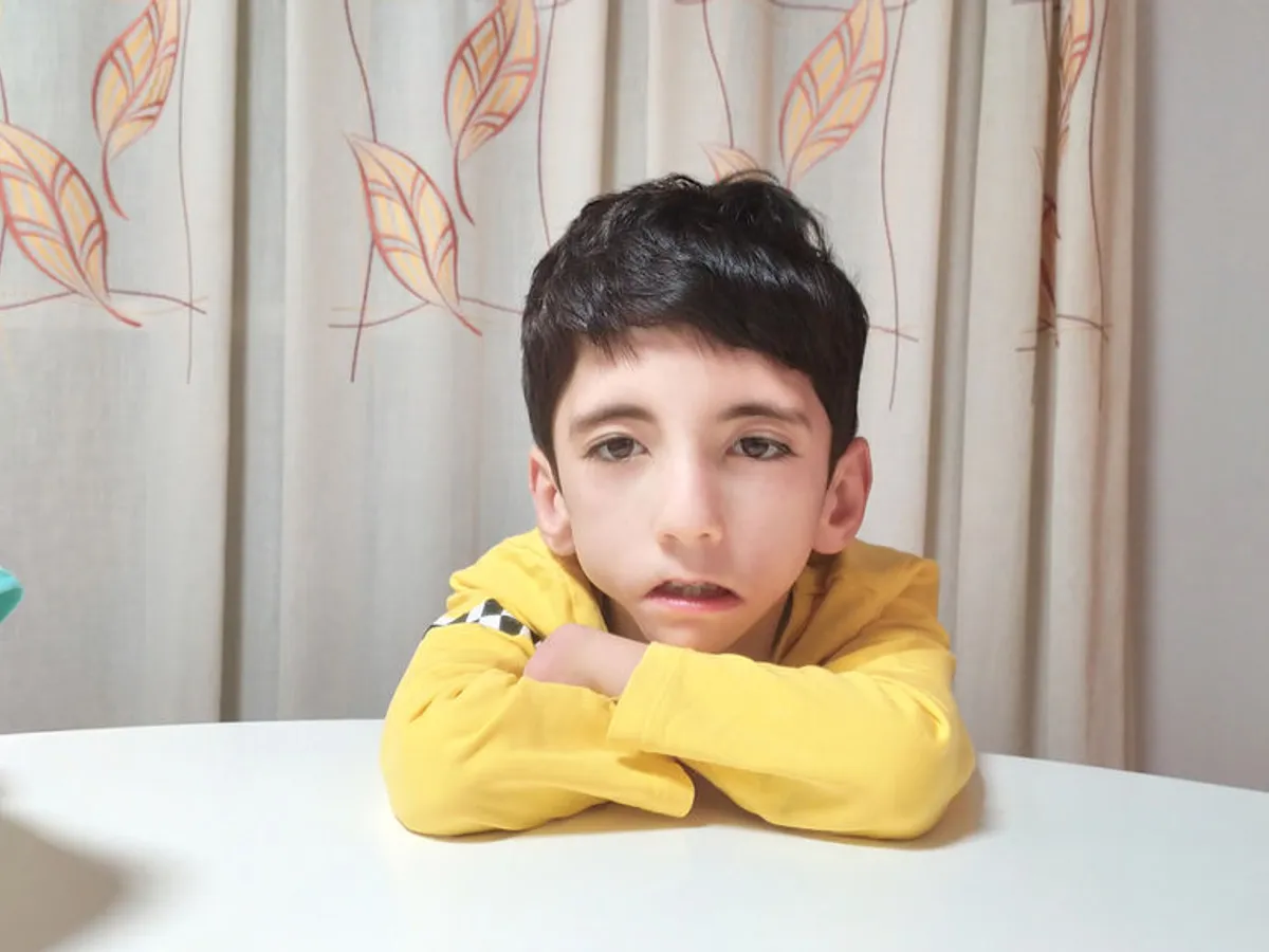 Síndrome de Moebius: Parálisis facial congénita - NeuroClass