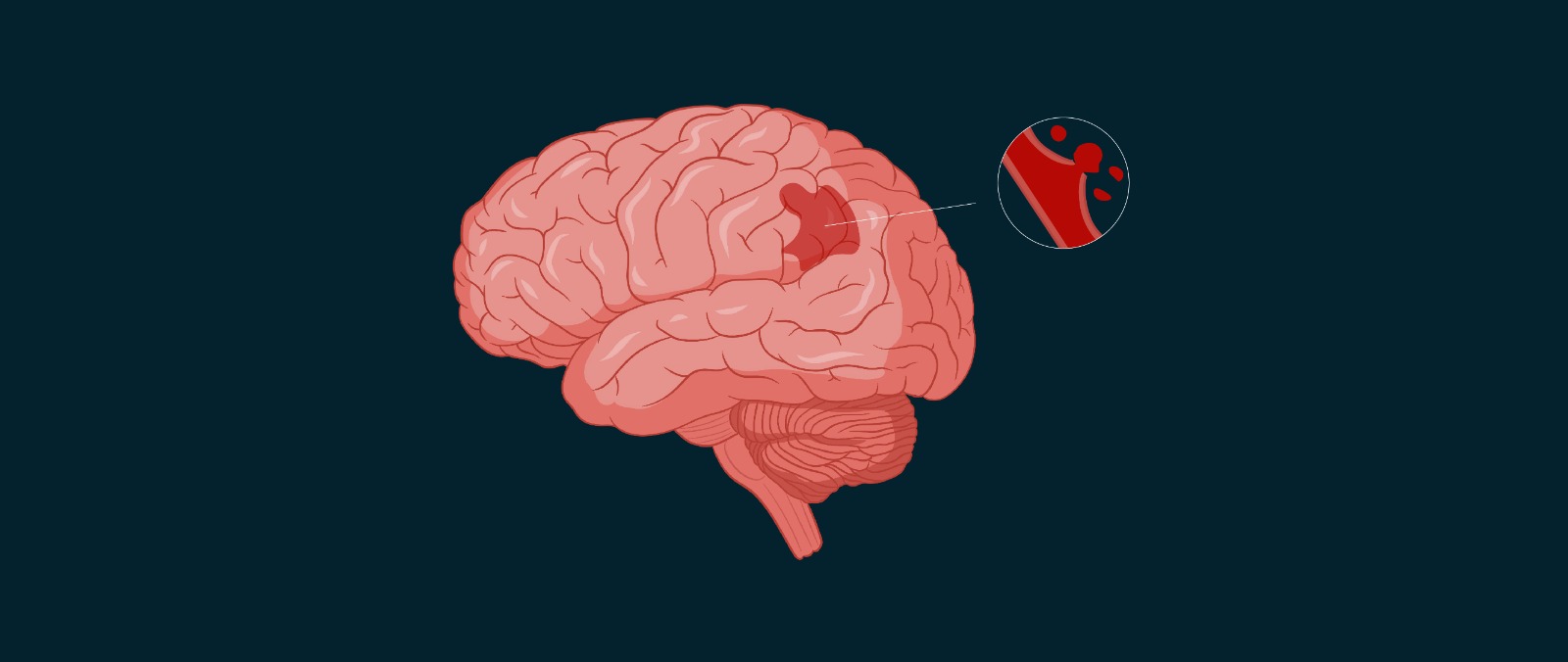 ACV hemorrágico: Consecuencias y abordajes - NeuroClass